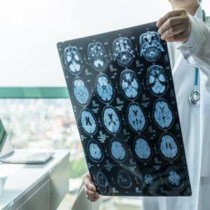 Tpa As Stroke Treatment: Pros And Cons